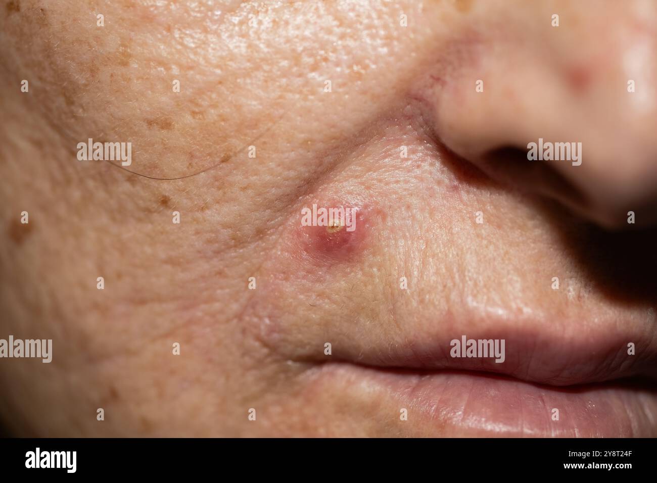 Close-up of a pimple on a woman's face. Pimple on face. Pimples and ...