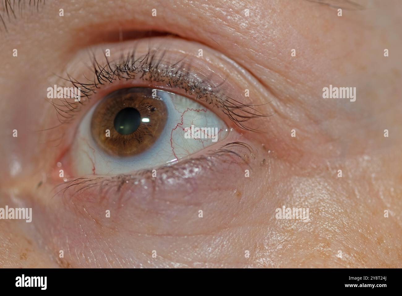 Human eye broken blood vessels hi-res stock photography and images - Alamy