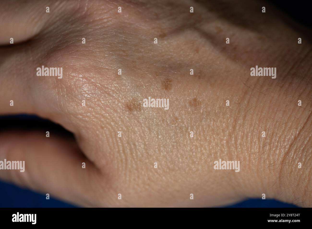 Brown spots on the hands of a middle-aged woman.Çiller, Skin Problems ...