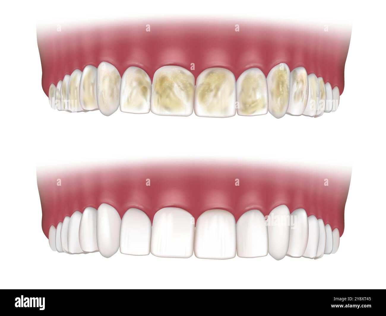 Deep Teeth Cleaning. Before and After. Teeth whitening concept. Dental ...