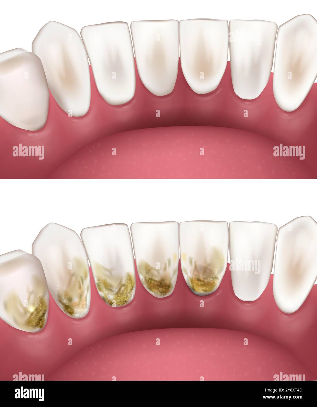 Deep Teeth Cleaning. Before and After. Teeth whitening concept. Dental ...