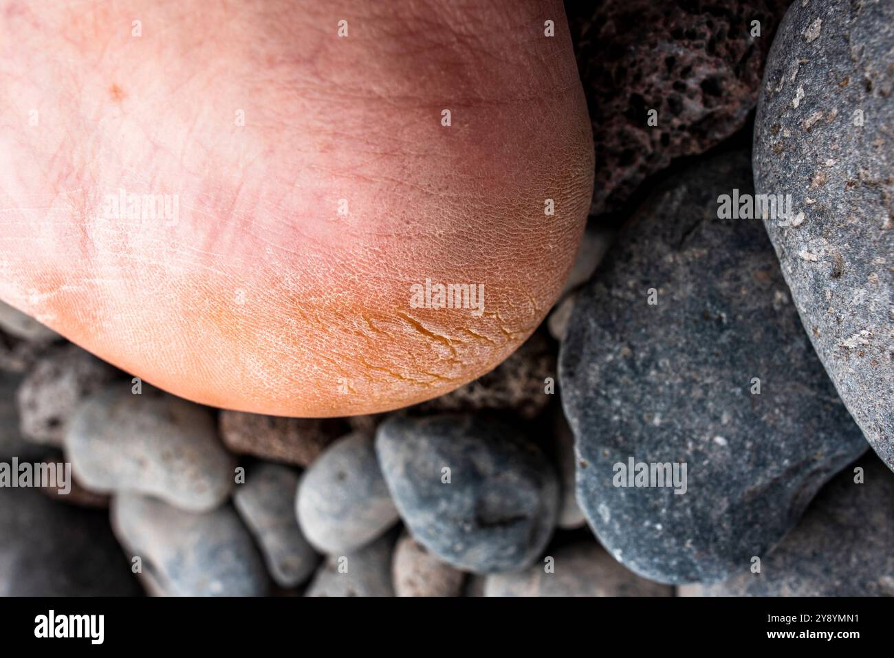 sores and cracked skin in the heel of an adult man's foot with volcanic ...