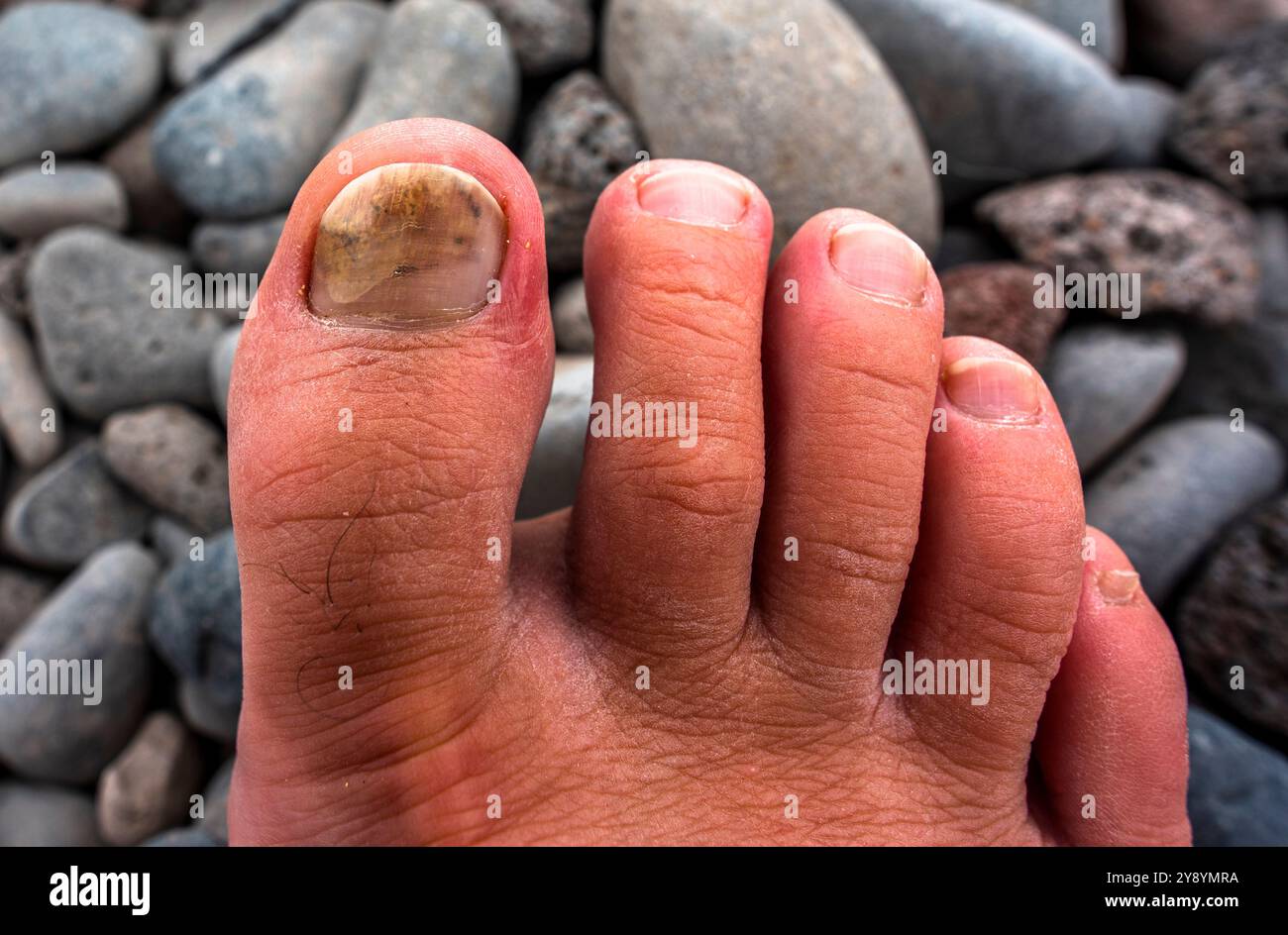 right big toe nail blackened by a crush and by the tight shoes of a ...