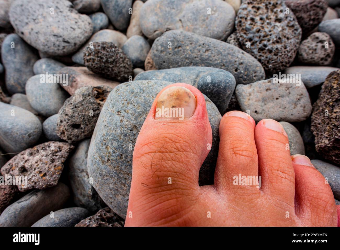 right big toe nail blackened by a crush and by the tight shoes of a ...