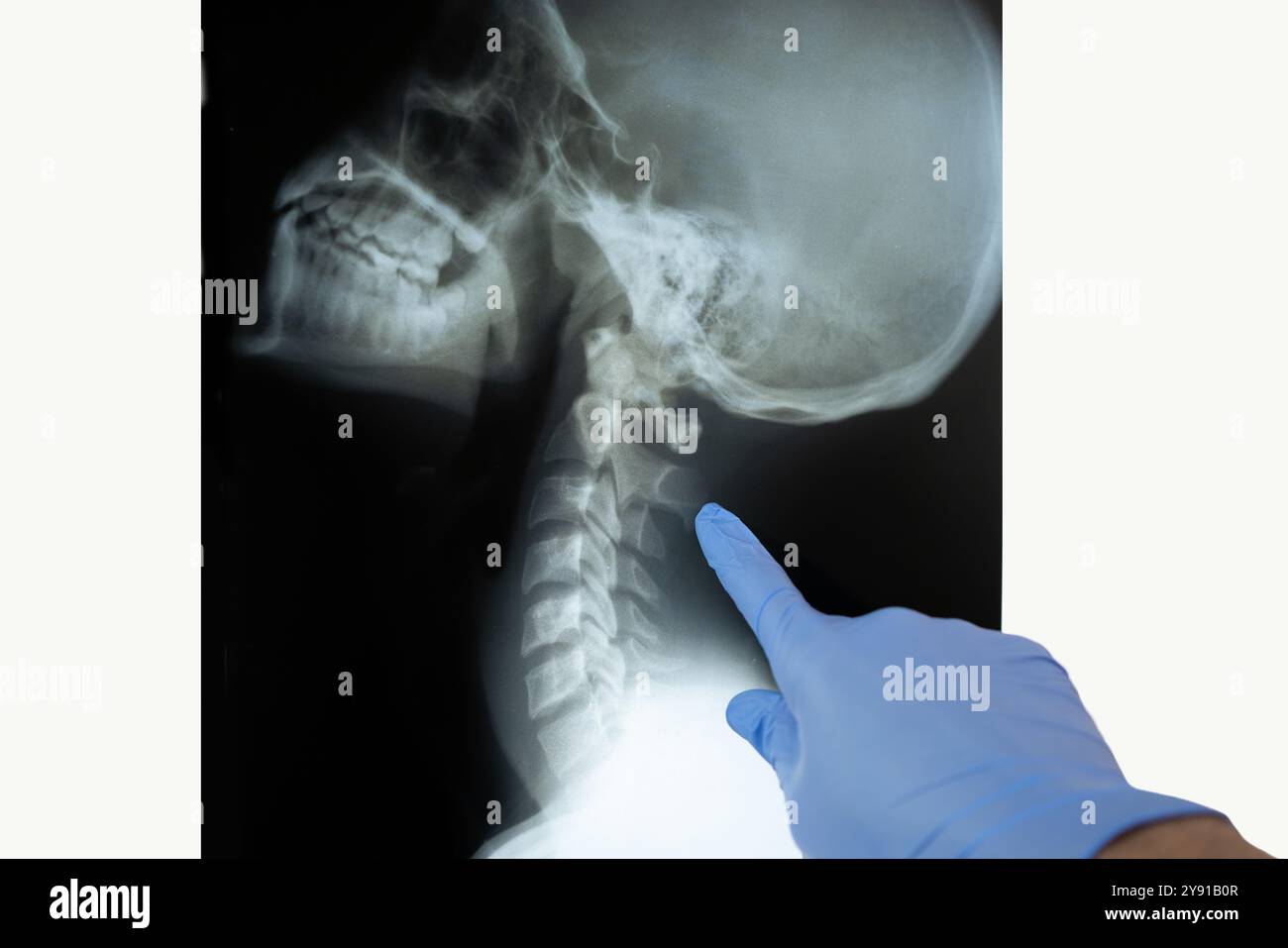Ray x imaging of the neck. MRI vertebral discs in different views Stock ...