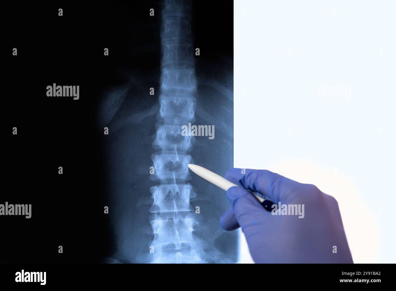 Doctor radiologically analyzing the human spinal column with x-ray ...
