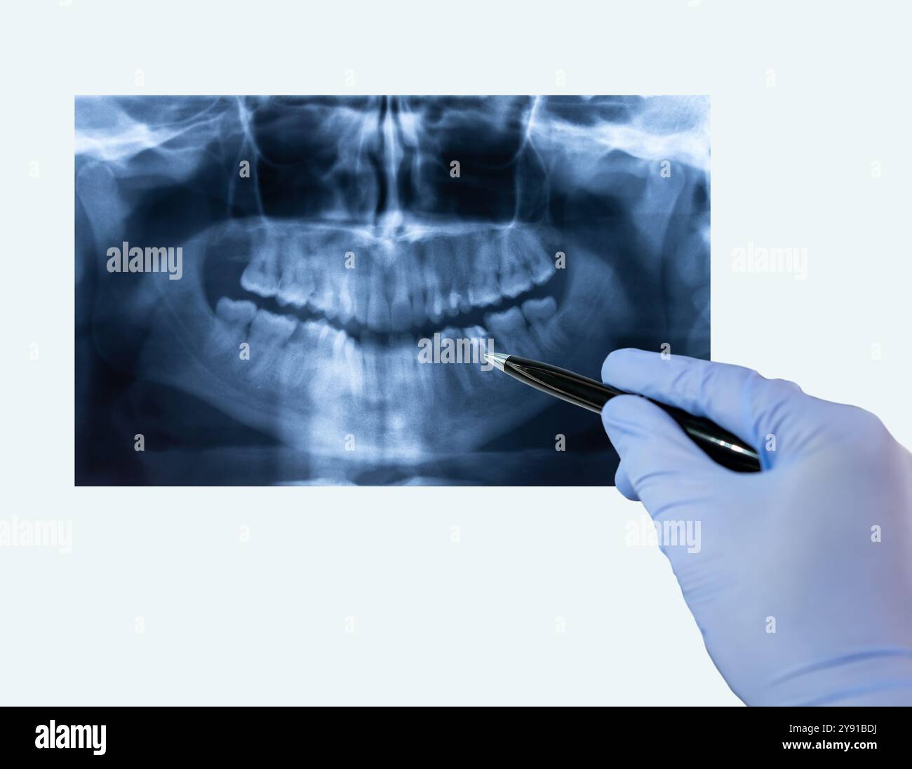 Close-up of male doctor pointing at teeth x-ray image at dental office ...