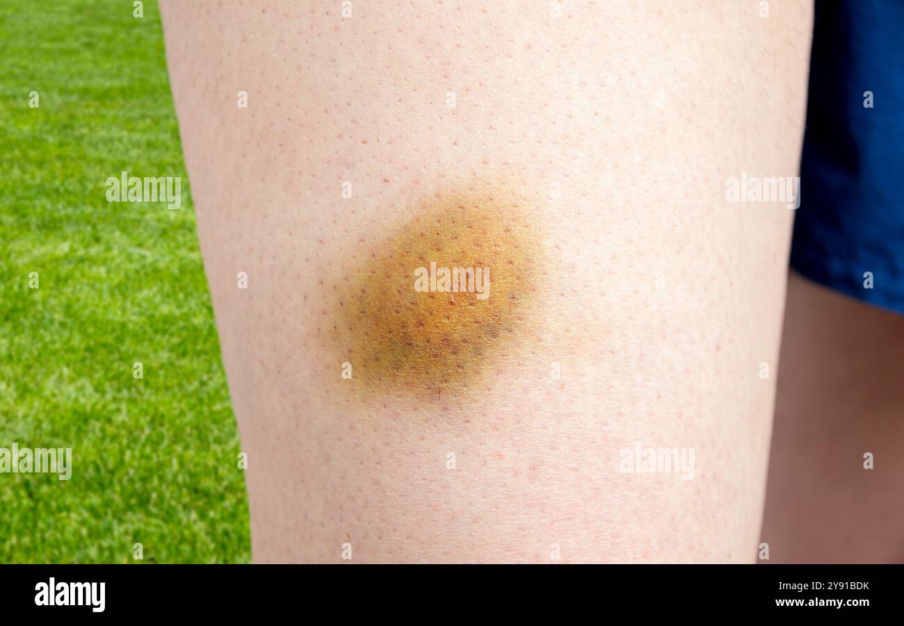Bruise leg hi-res stock photography and images - Alamy