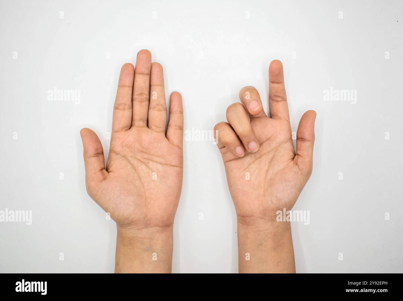 Ulnar claw hand compared to normal hand of Asian young woman. develops ...