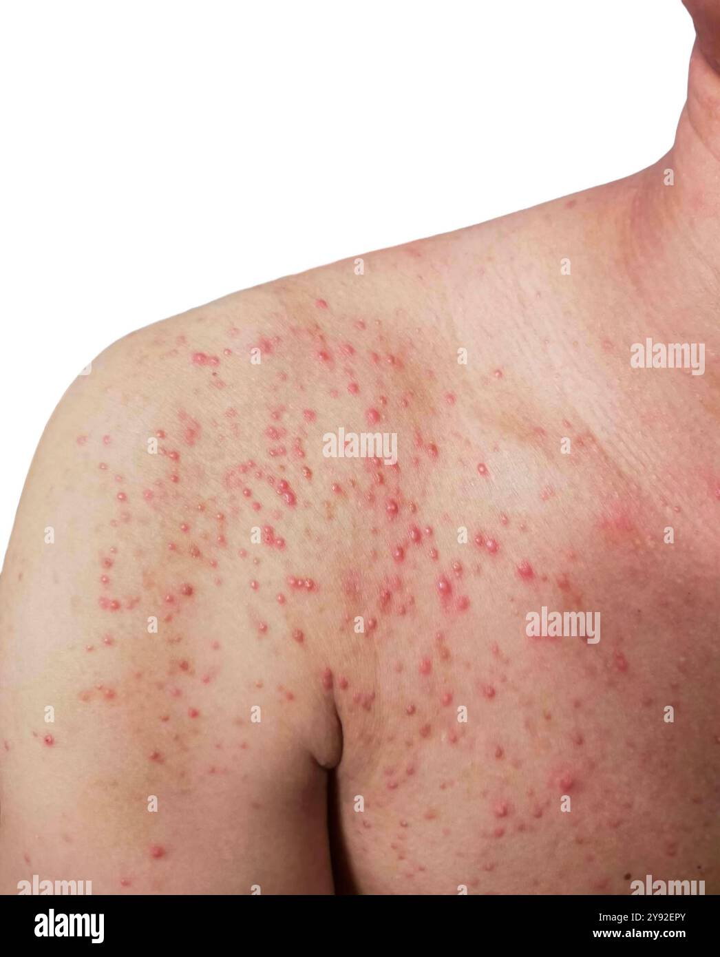 Herpes zoster rash blisters hi-res stock photography and images - Alamy