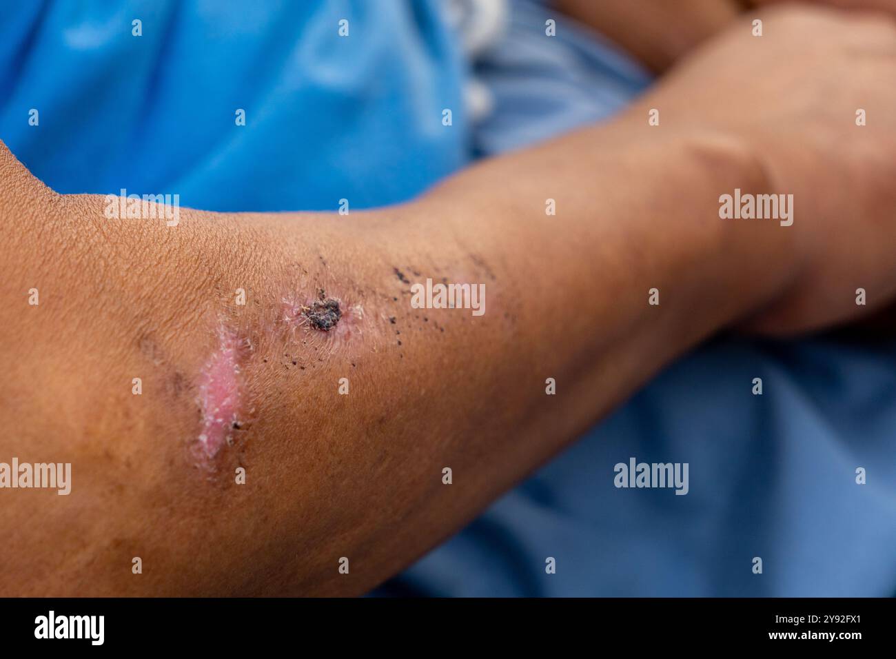 Wound documentation hi-res stock photography and images - Alamy