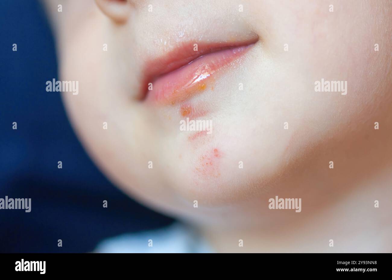Selective focus on the chin of a young child. The chin has abrasions ...