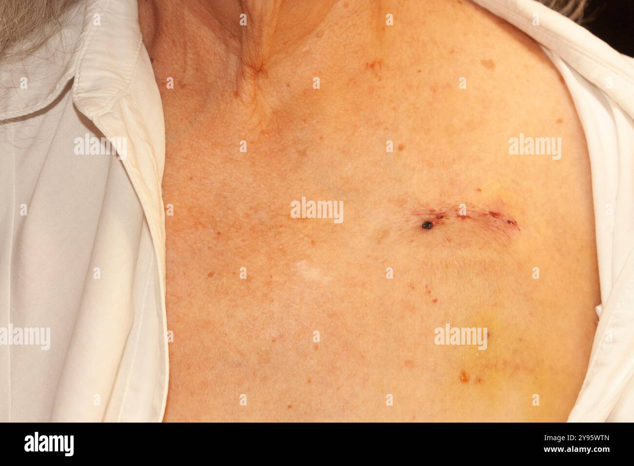 Post-surgical scar on elderly person's chest for pacemaker installation ...