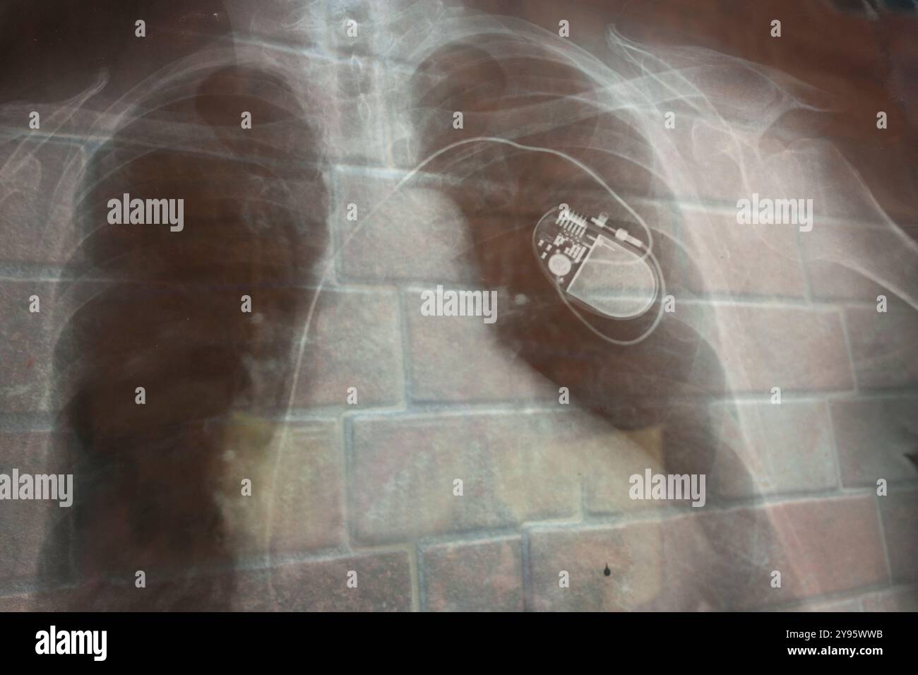 X-ray showing pacemaker implanted in the chest Stock Photo - Alamy