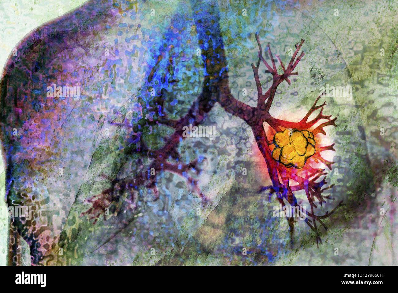 Tumour hi-res stock photography and images - Alamy