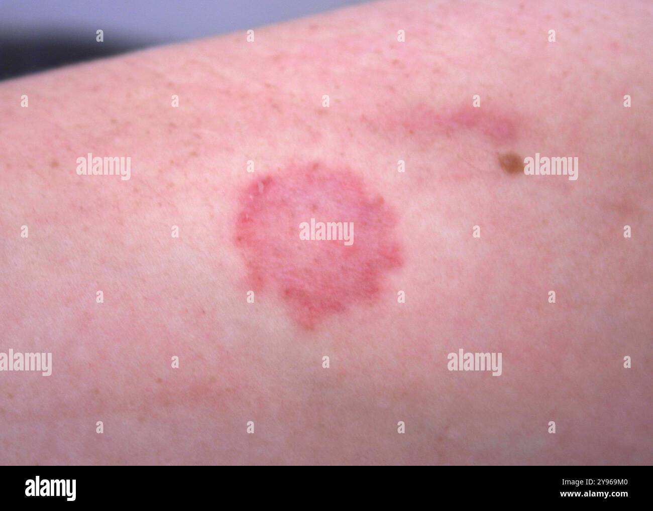 Ringworm infection on the arm of a 20 year old female. Ringworm is a ...