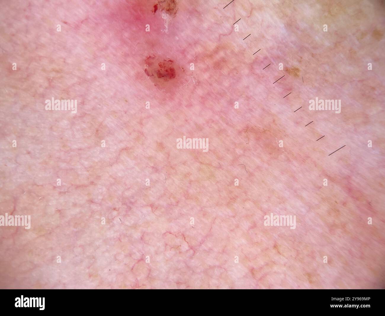 Basal cell carcinoma, dermoscopy Stock Photo - Alamy