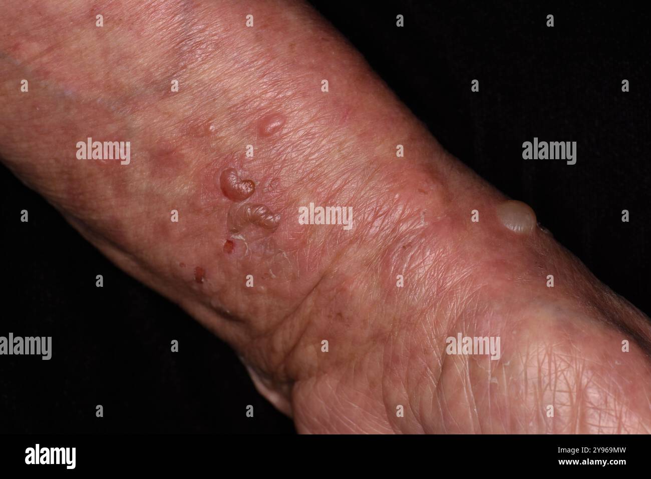 Not to be used for advertising or in a defamatory context Bullae on the ...