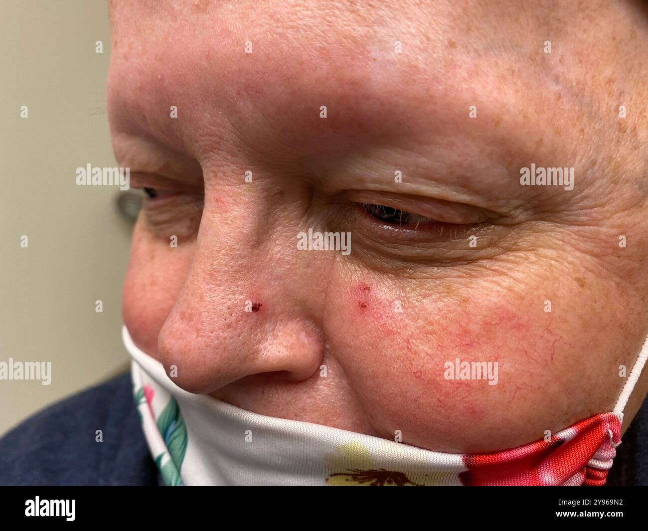 Editorial use only Nodular ulcerative basal cell carcinoma (BCC), or ...