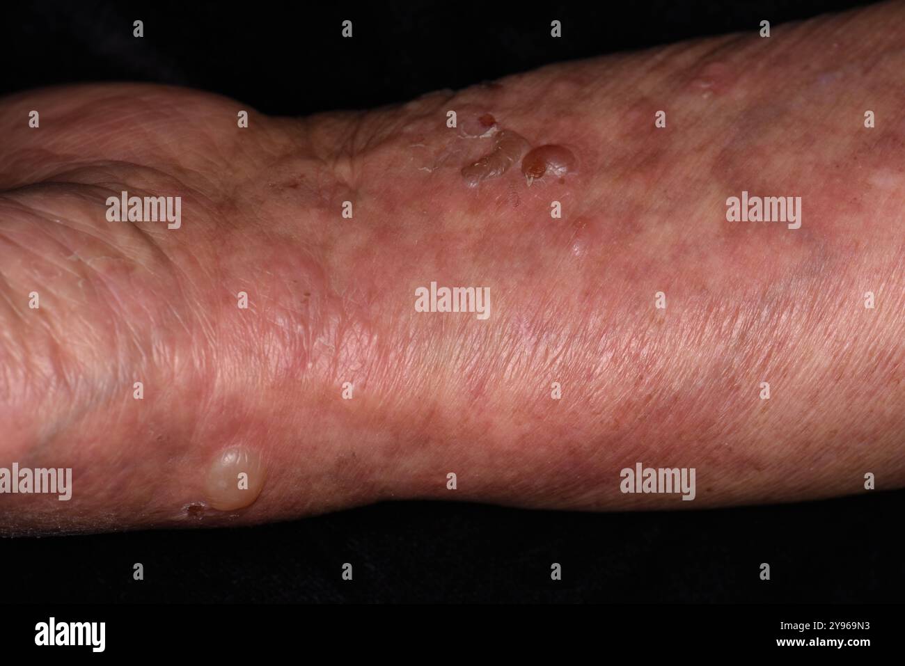 Not to be used for advertising or in a defamatory context Bullae on the ...