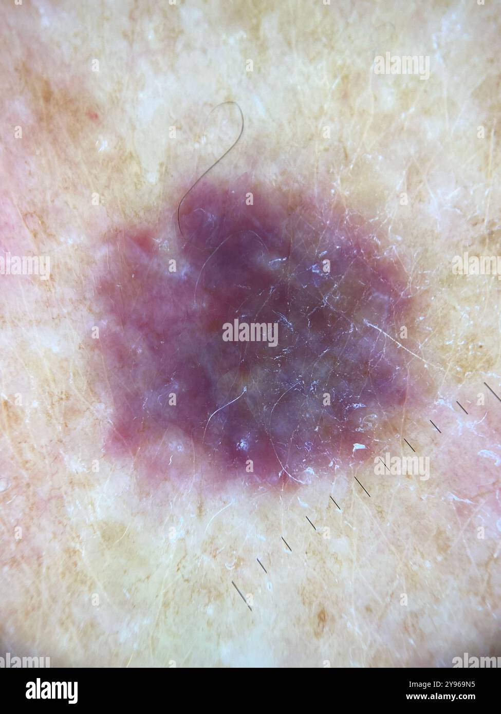 Dermatoscope image of a bruise (ecchymosis) on the arm of a 70 year old ...