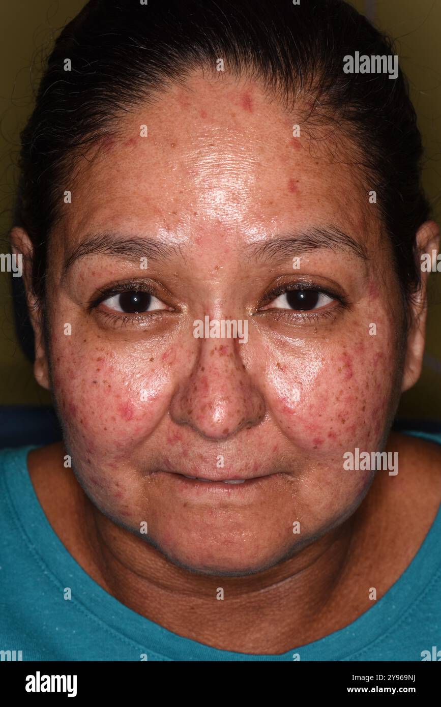 Editorial use only Telangiectasias on the face of a 55 year old ...
