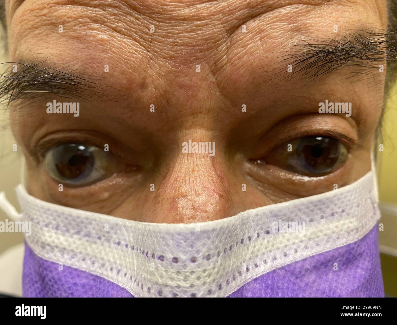 Editorial use only Minocycline hyperpigmentation affecting the whites ...