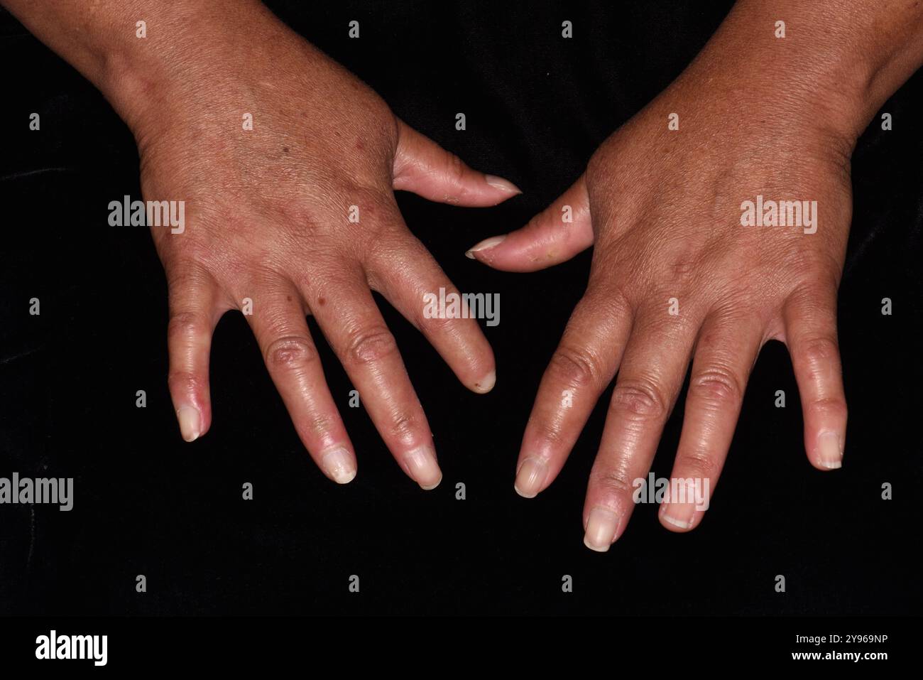 sclerodactyly of the fingers of a 55 year old Hispanic female patient ...