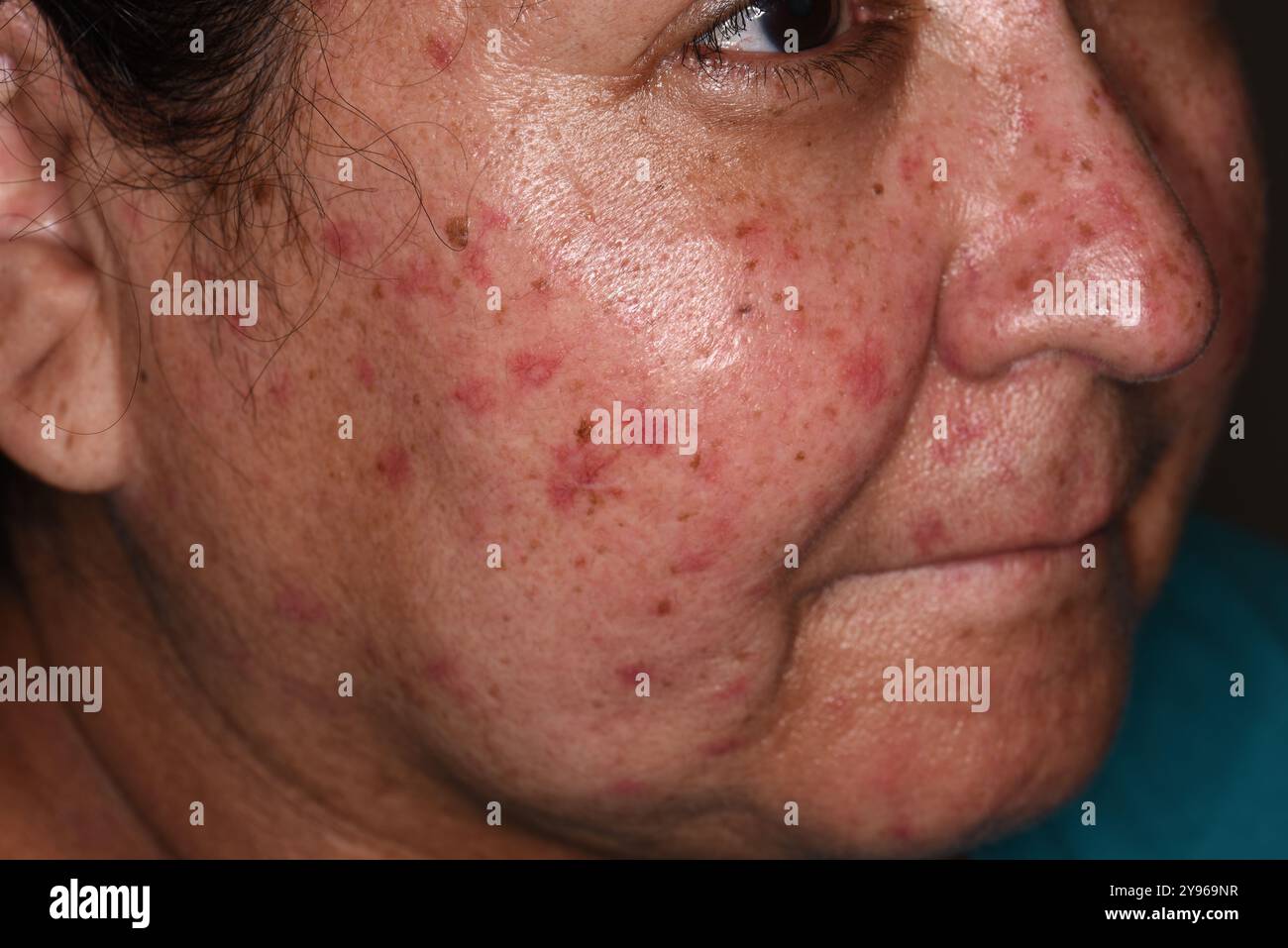 Telangiectasias on the face of a 55 year old Hispanic female patient ...