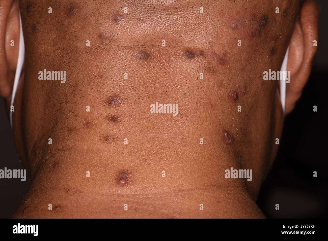 Nodular prurigo on the back of a male African-American patient's neck ...