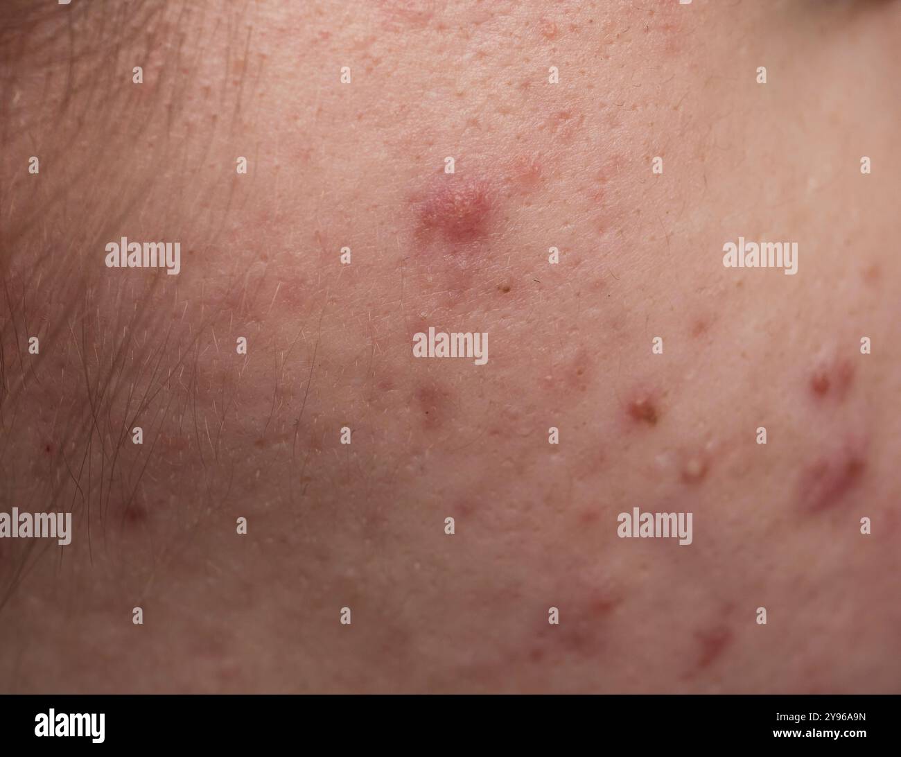 Many pimples. Bad skin. Hormonal acne, puberty. Skin acne background ...