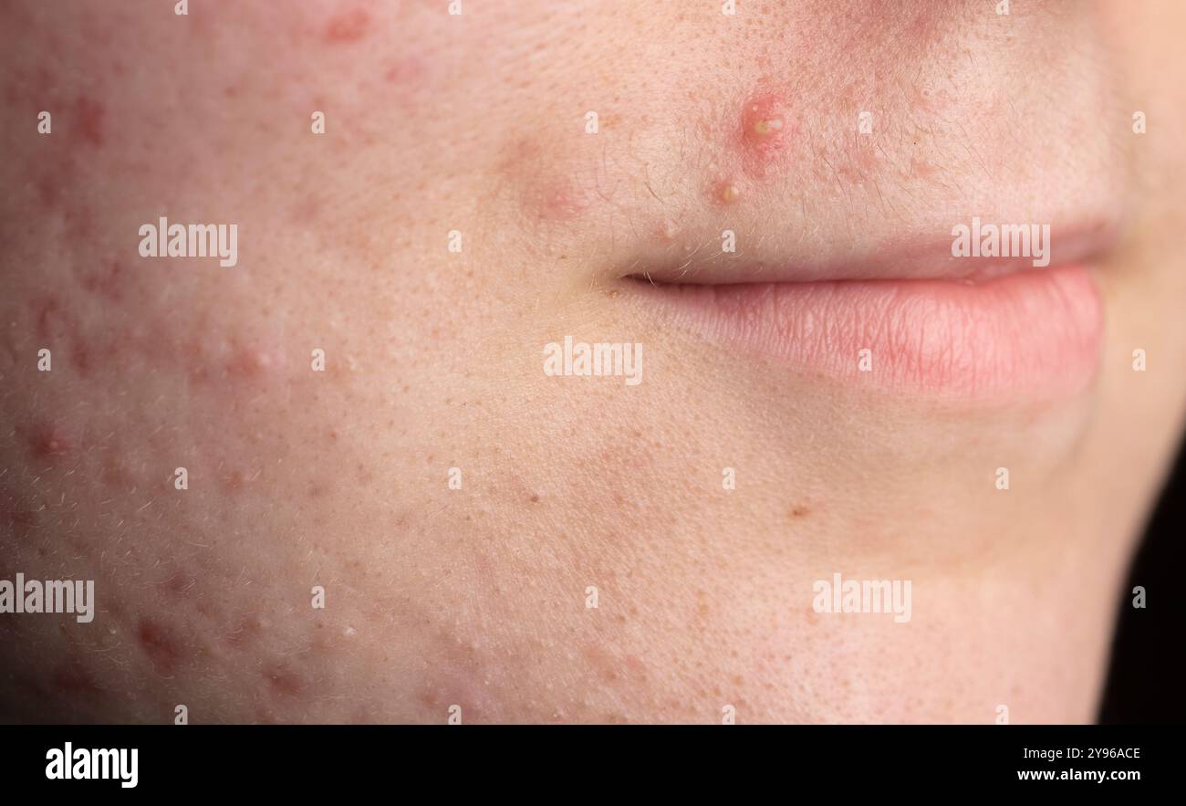 Pimple, acne, scar on skin, facial problem. Bad skin. Face with rash ...