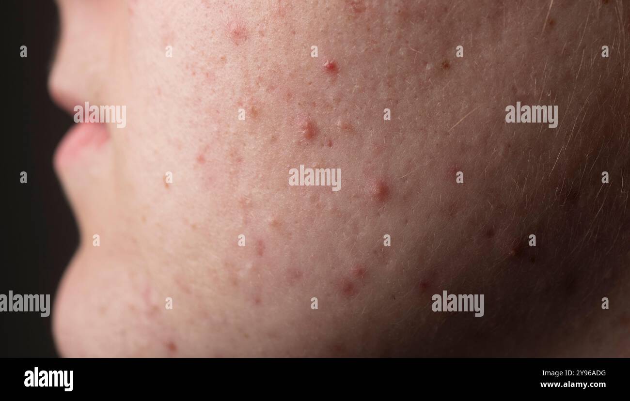 Skin health problem, skin diseases. Skin acne background. Closeup acne ...