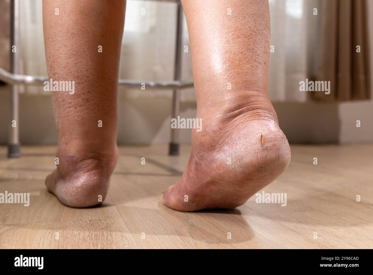 Woman's leg is edema (swelling) after cancer treatment Stock Photo - Alamy