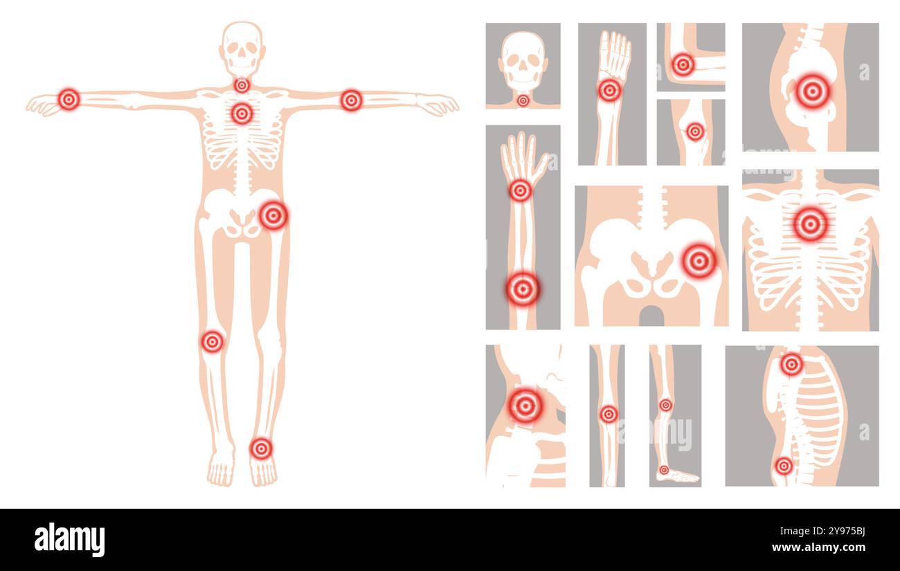 Human figure highlighting common pain points linked to rheumatic ...