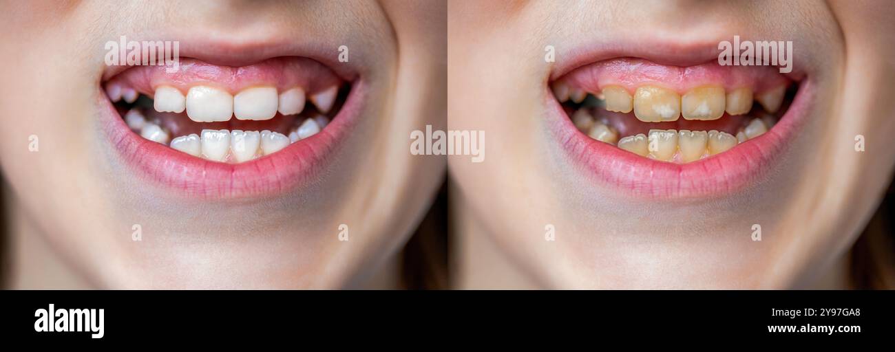 Child teeth before and after. Child shows teeth with stains and plaque ...