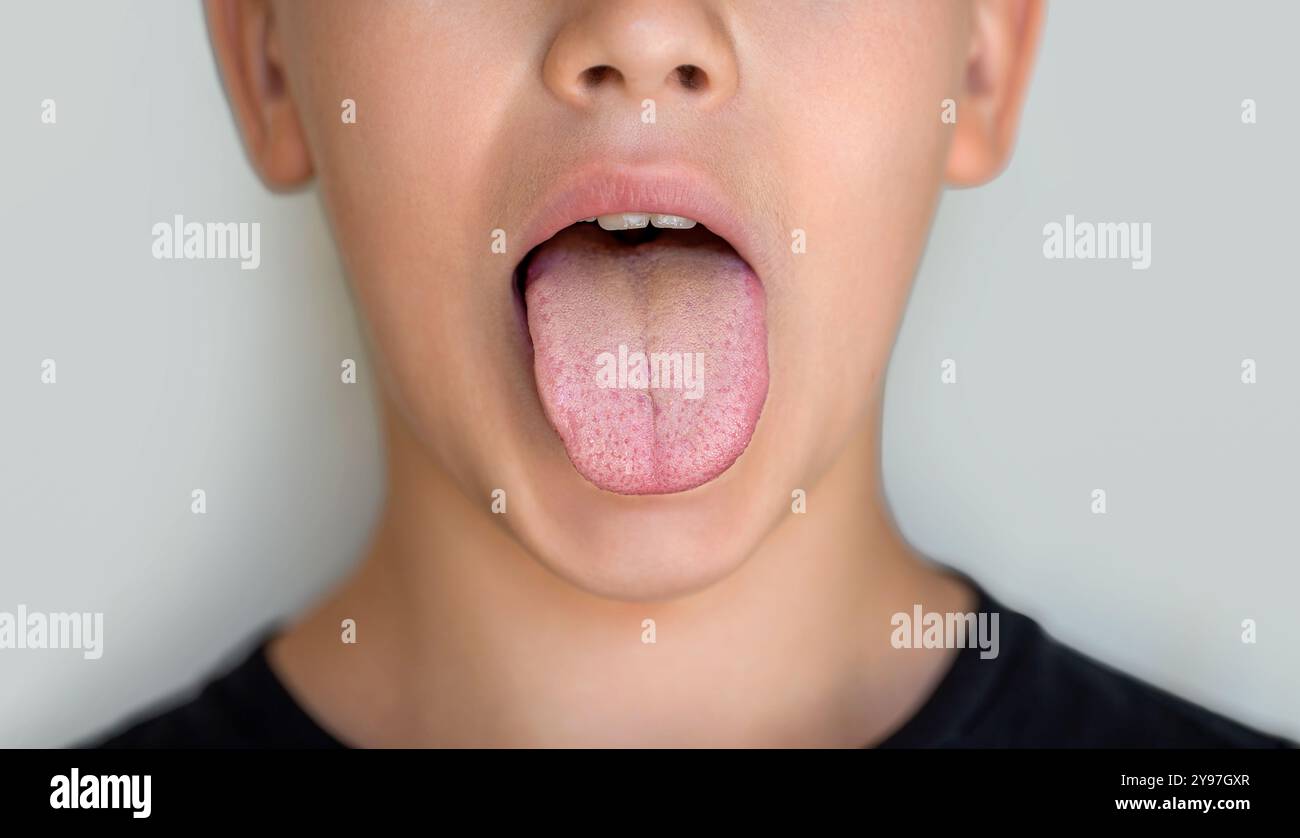 White coating on tongue child. Oral thrush. Boy showing her tongue ...