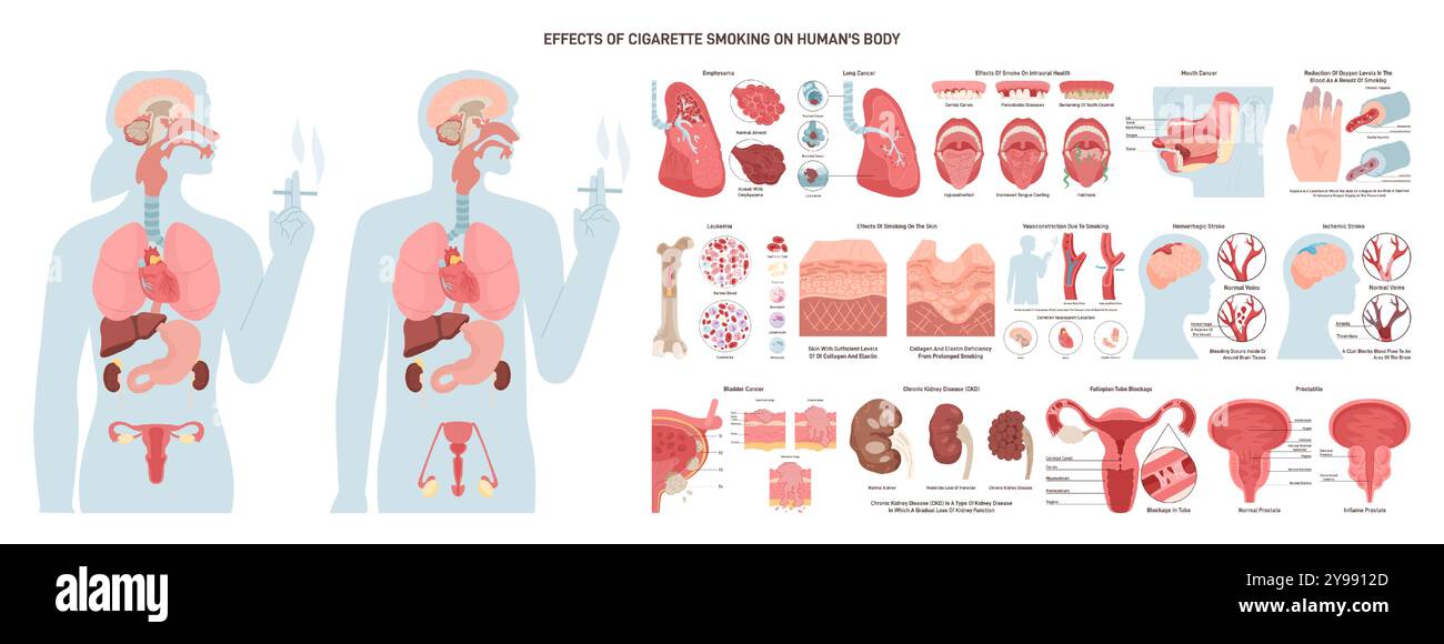 Effects of cigarette smoking on human body. Health issues and risks of smokers. Human internal ...