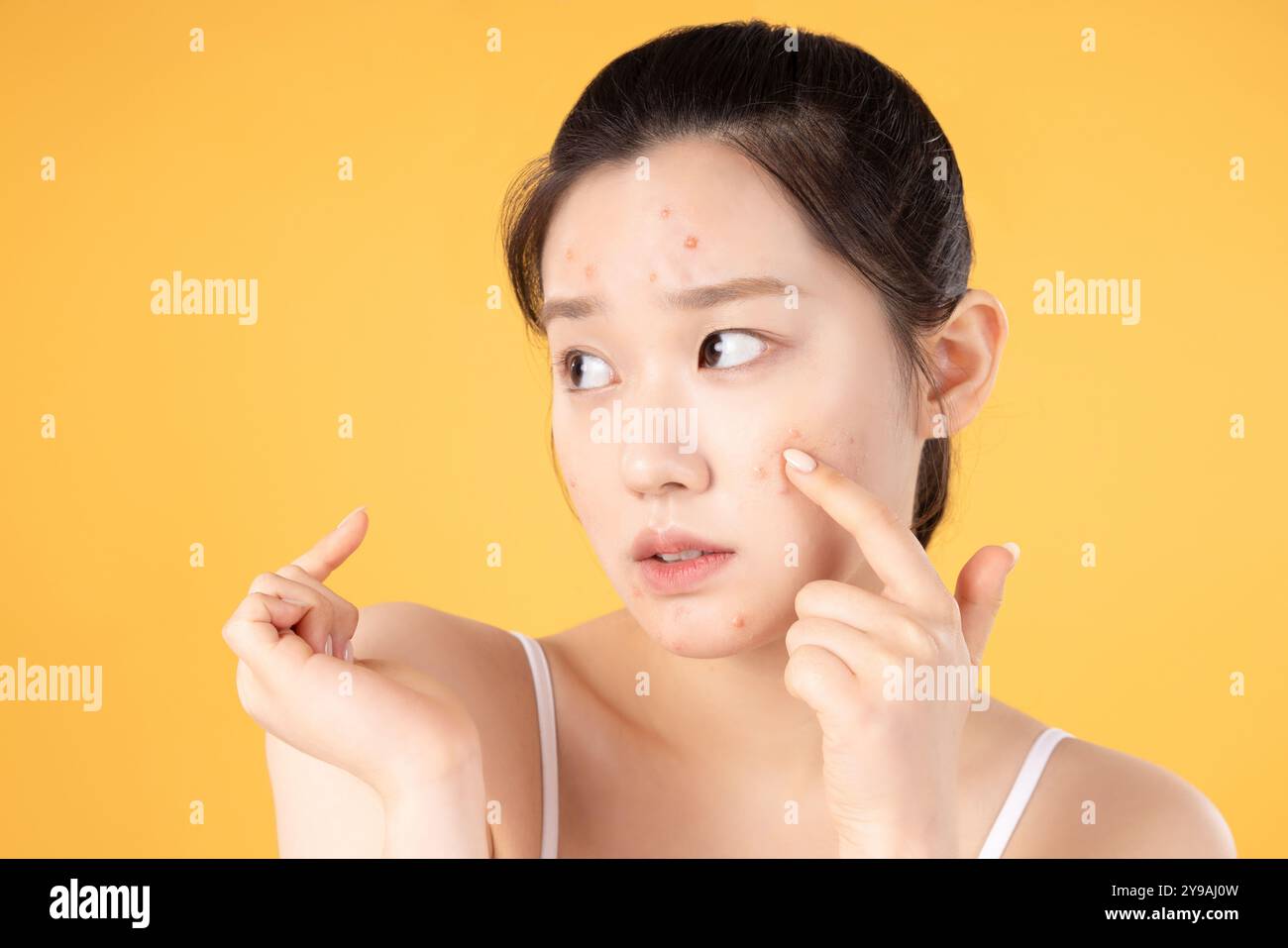Teenage woman using ointment to remove skin problems on her face Stock ...