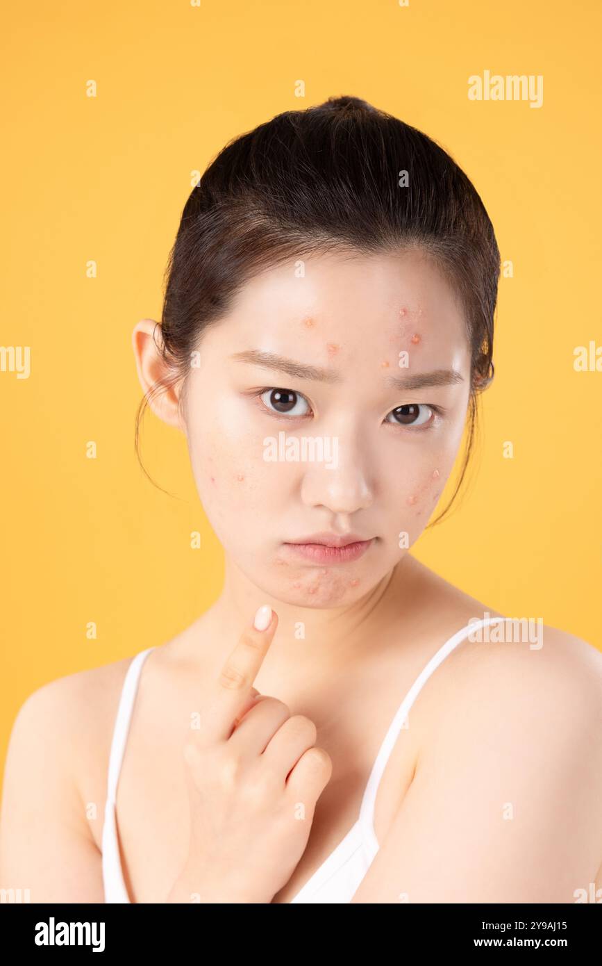 Teenage woman using ointment to remove skin problems on her face Stock ...