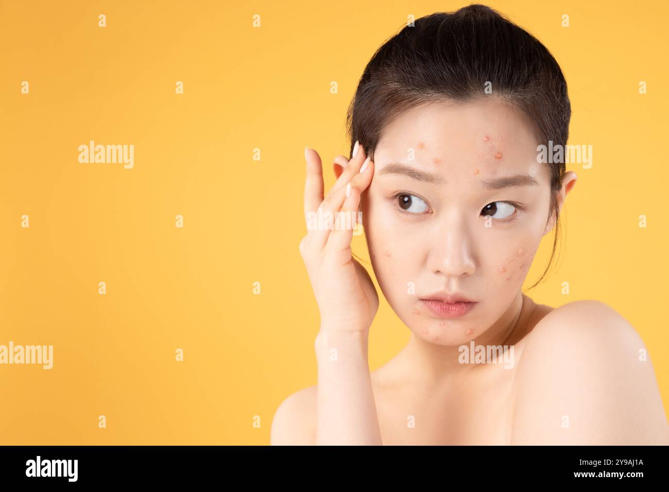 Teenage woman using ointment to remove skin problems on her face Stock ...