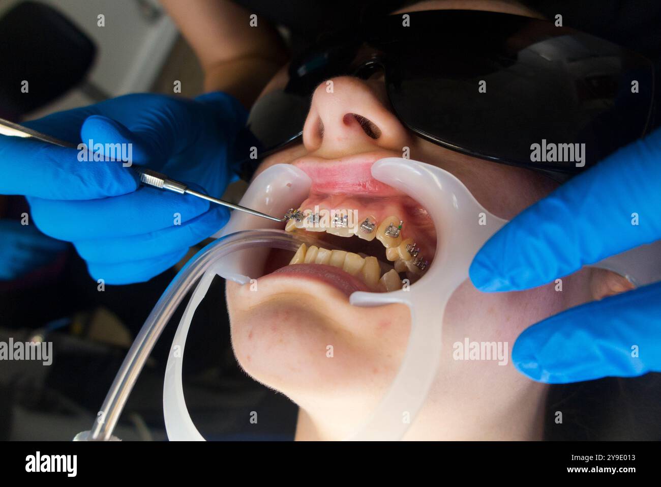 Brackets being glued / attached on to teeth of young girl aged 12 years ...
