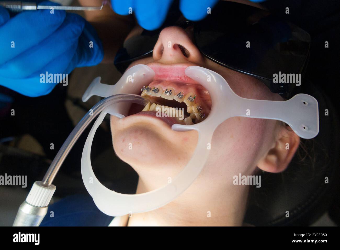Brackets being glued / attached on to teeth of young girl aged 12 years ...