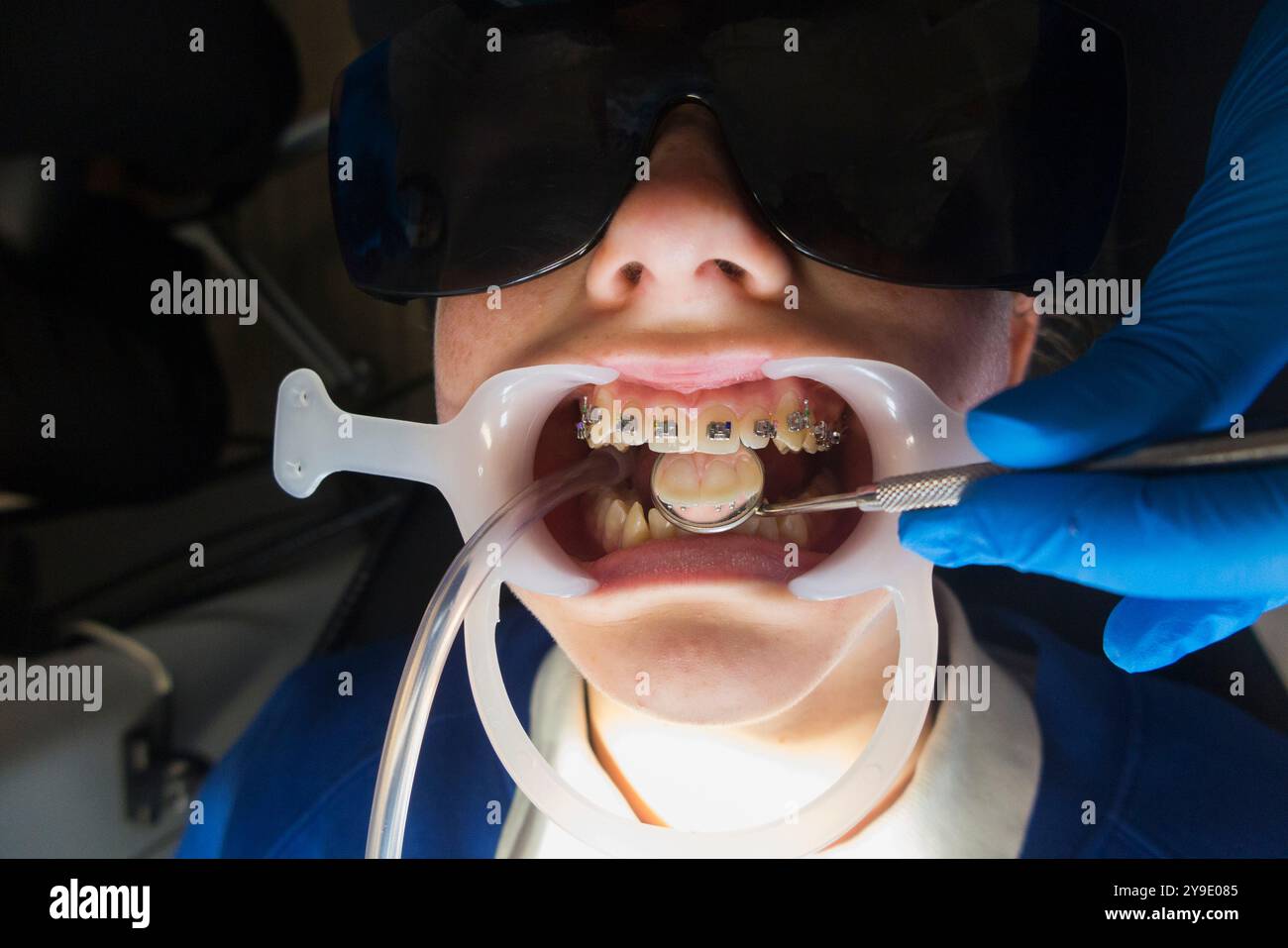 Brackets being glued / attached on to teeth of young girl aged 12 years ...