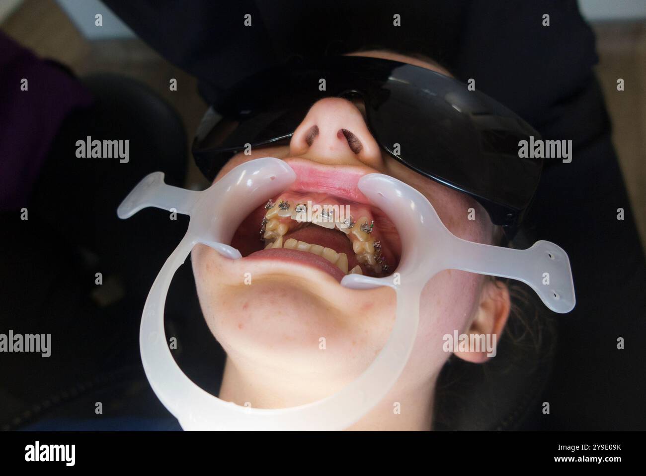 After being glued and hardened with ultraviolet light, brackets can be ...