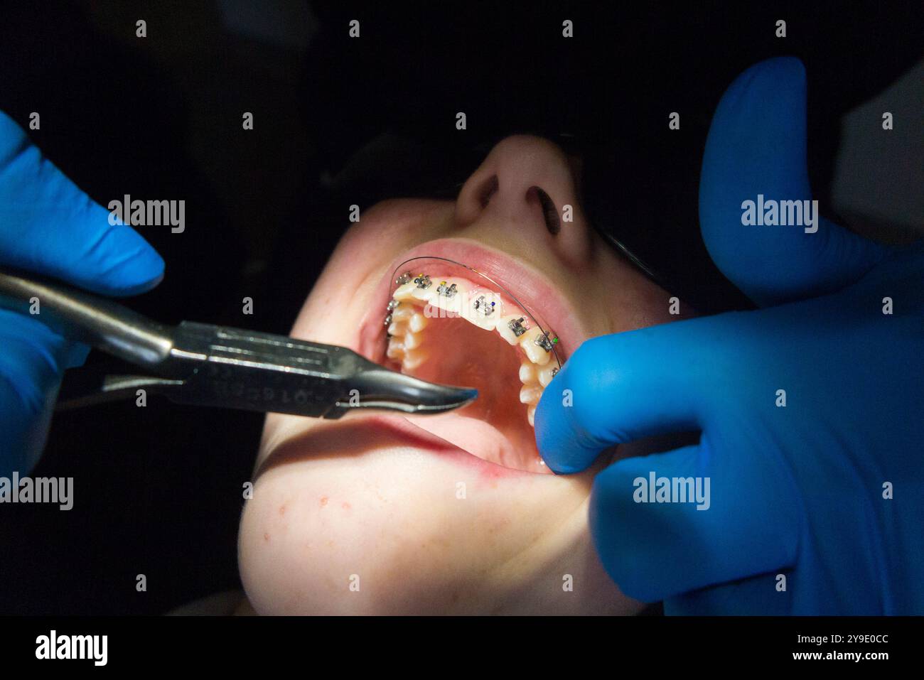 Young girl aged 12 years gets NHS dental braces, brace, fitted to her ...