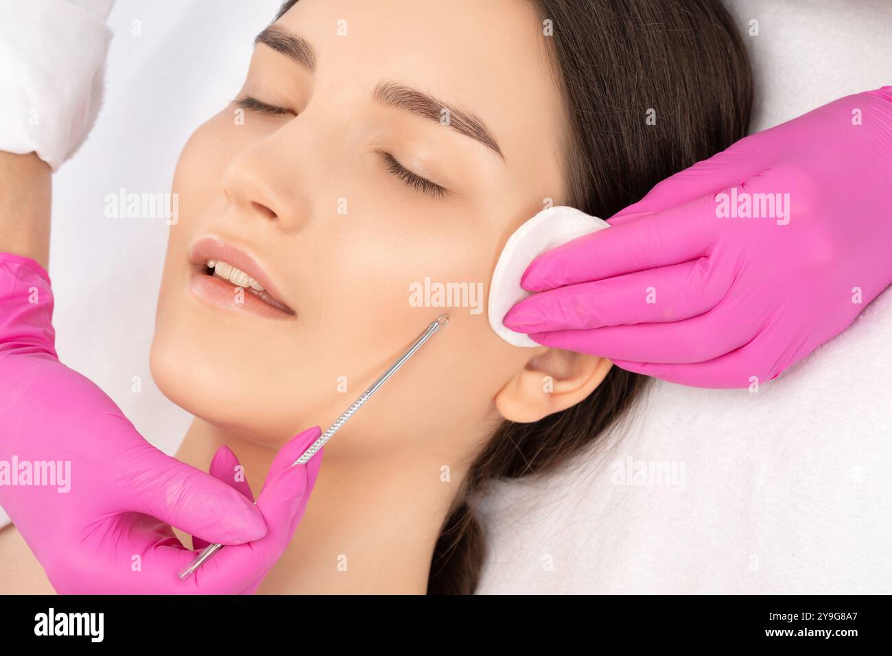 A procedure for cleansing the skin of the face from blackheads and acne ...