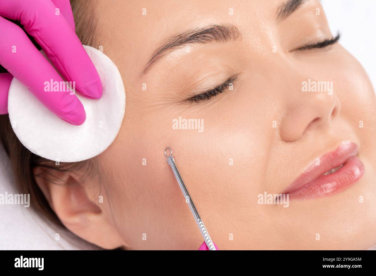 A procedure for cleansing the skin of the face from blackheads and acne ...