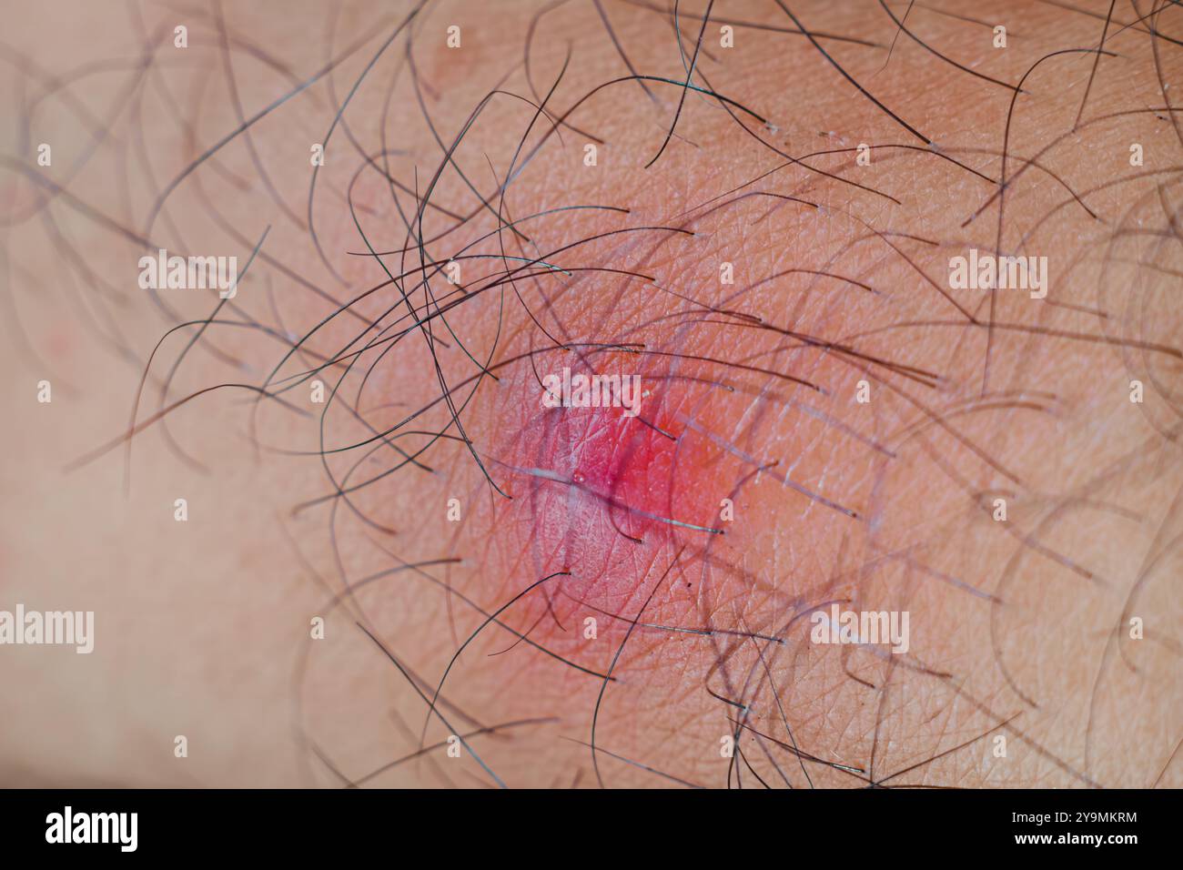 Macro shot of an inflamed skin pore with hair follicles and a small pus ...