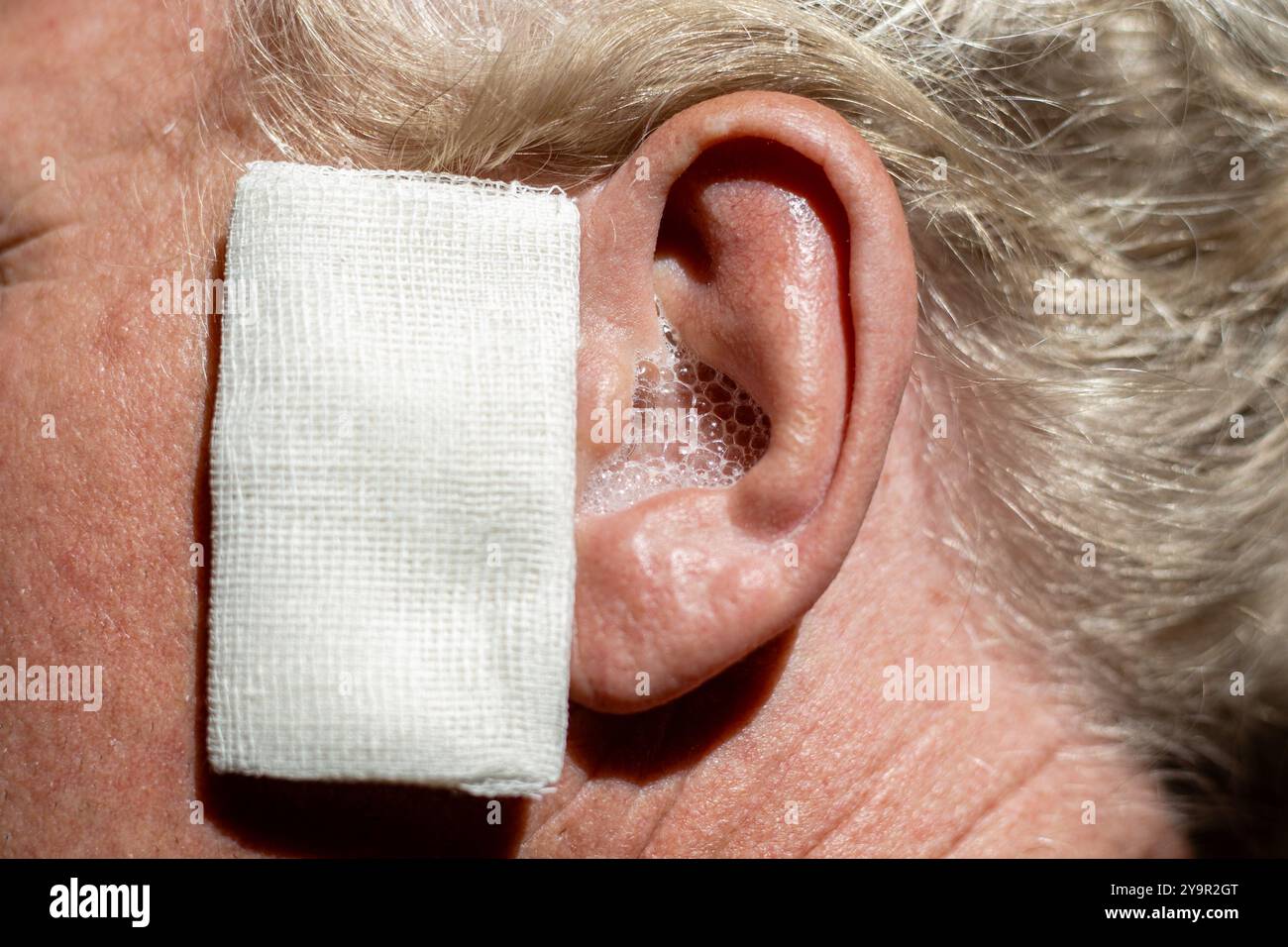 Ear diseases. Dropping hydrogen peroxide into a man's ears to soften ...